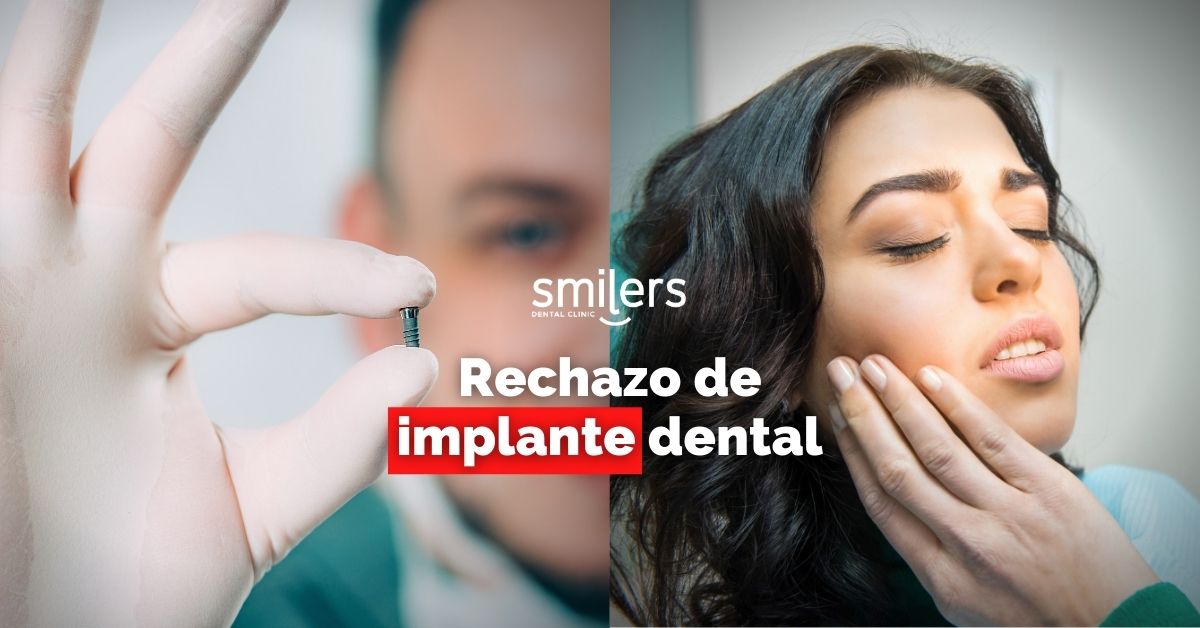 Why Does a Dental Implant Rejection Occur?