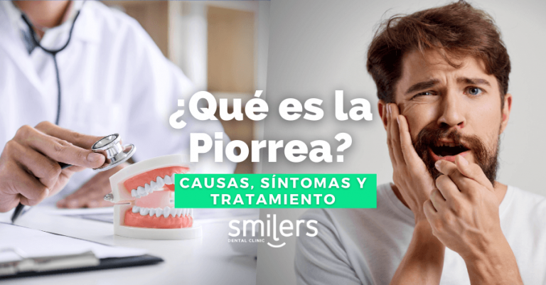 What is Pyorrhea or acute periodontitis? Causes, symptoms, and treatment.