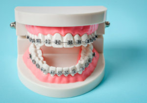 Dentistas Mexicali | Smilers clínica dental en Mexicali